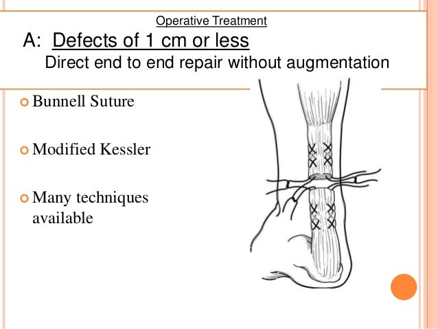 TA Rupture - DR Chandramani Roy