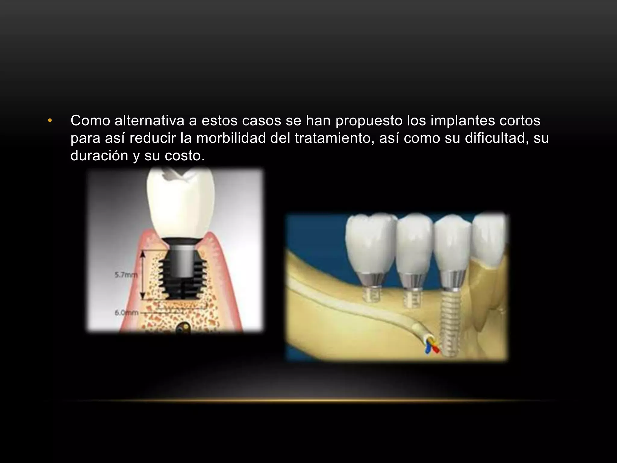 Implantes dentales cortos vs Largos | PPT