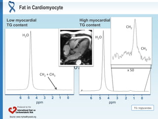 Ectopic Fat: An Important Feature of Intra-Abdominal Obesity in Type 2 ...