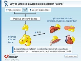 Ectopic Fat: An Important Feature of Intra-Abdominal Obesity in Type 2 ...