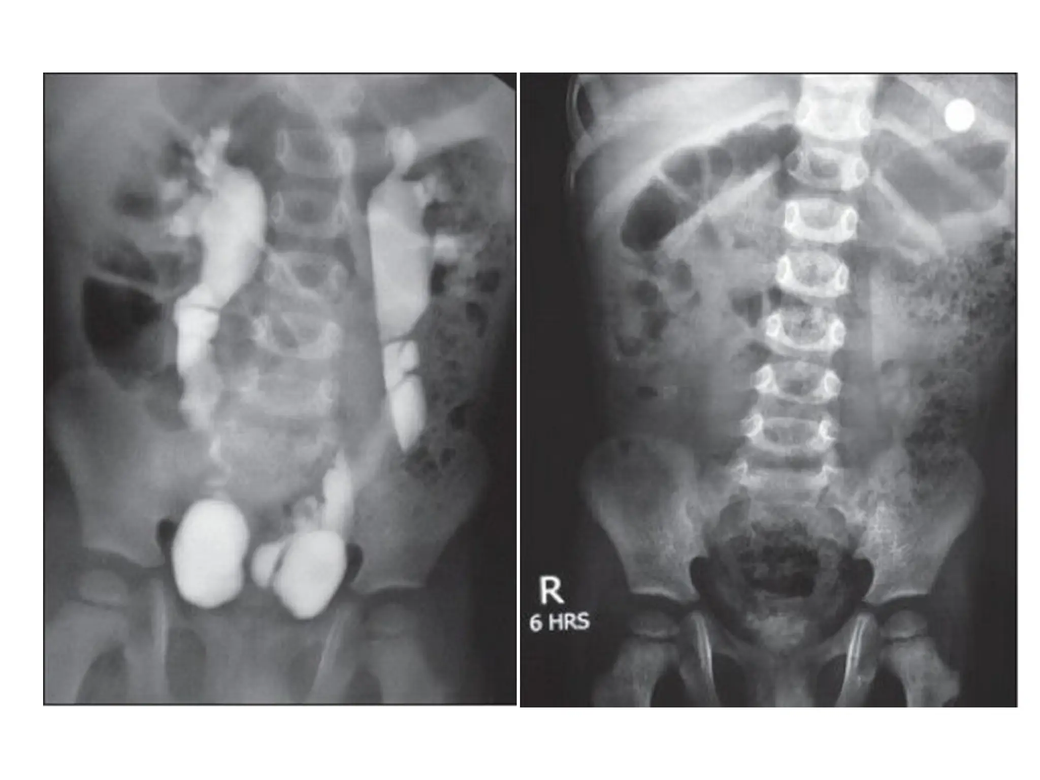 IVU radiology and imaging urogenital contrast | PPT