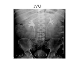 IVU radiology and imaging urogenital contrast | PPTX