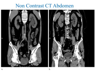 IVU radiology and imaging urogenital contrast | PPTX