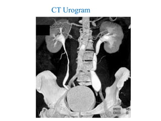 IVU radiology and imaging urogenital contrast | PPTX