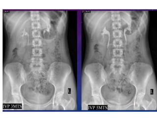 IVU radiology and imaging urogenital contrast | PPTX