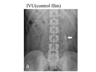 IVU radiology and imaging urogenital contrast | PPTX