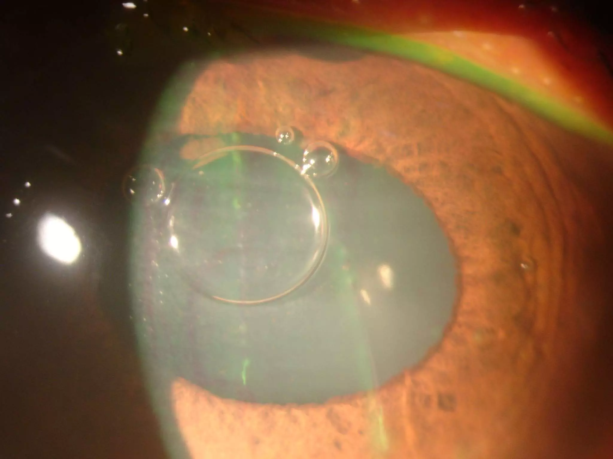 Causes of Toxic Anterior Segment Syndrome | PPTX | Eye and Vision ...