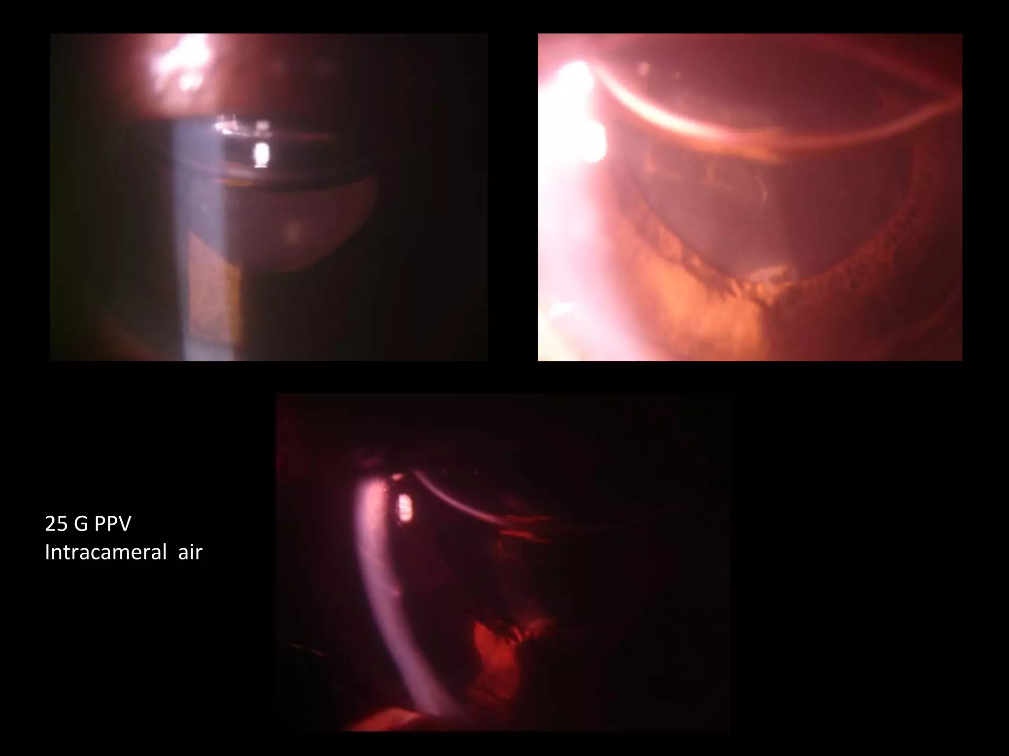 Causes of Toxic Anterior Segment Syndrome | PPTX | Eye and Vision ...