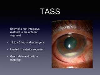 Causes of Toxic Anterior Segment Syndrome | PPTX | Eye and Vision ...