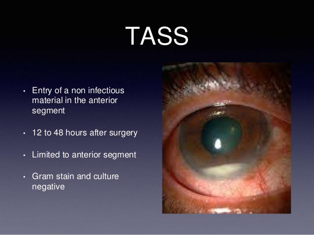 Causes of Toxic Anterior Segment Syndrome