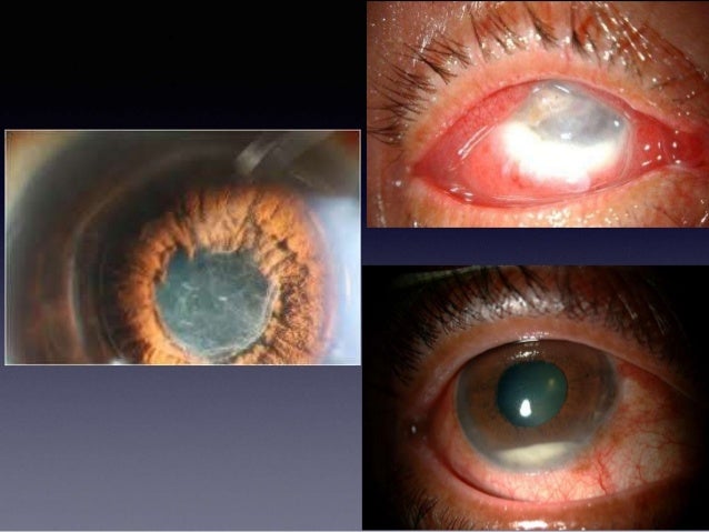 Toxic Anterior Segment Syndrome