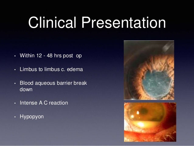 Causes of Toxic Anterior Segment Syndrome