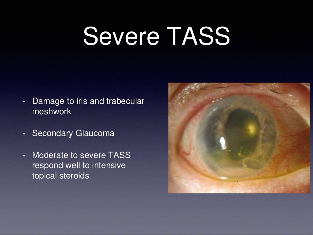Causes of Toxic Anterior Segment Syndrome