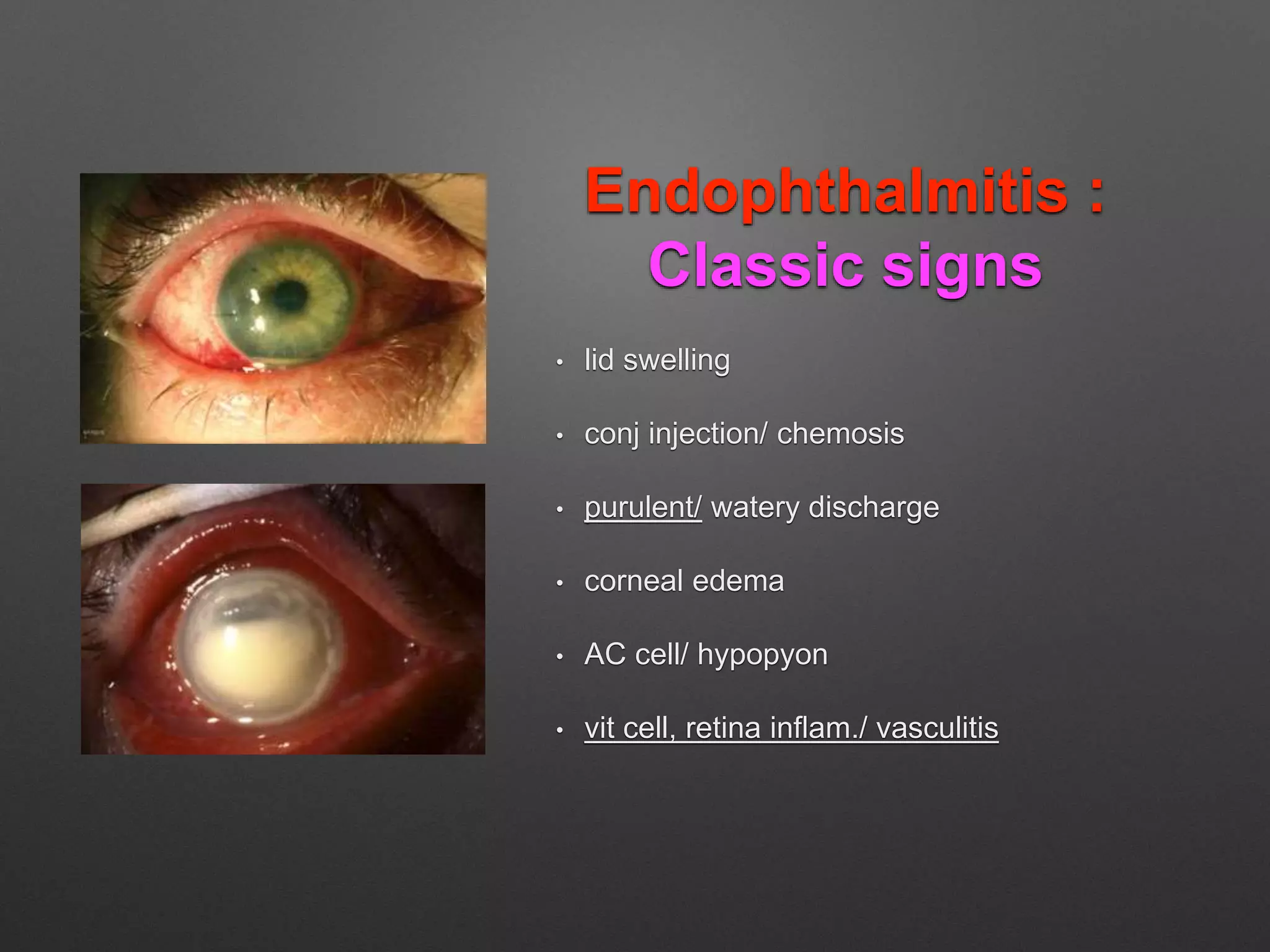 TASS vs Endophthalmitis | PPTX