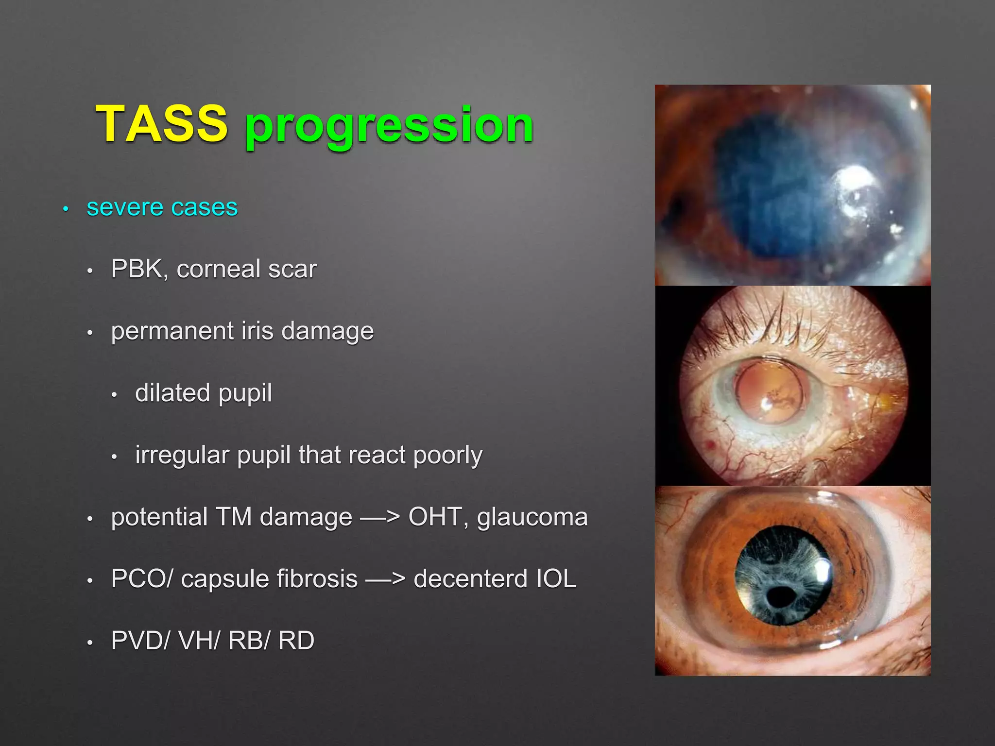 TASS vs Endophthalmitis | PPTX