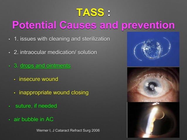 TASS vs Endophthalmitis | PPTX