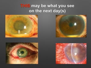 TASS vs Endophthalmitis | PPTX