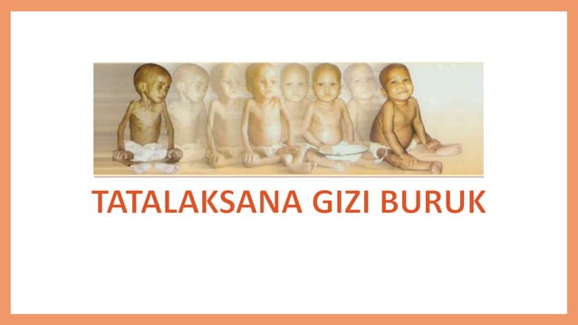 Tatalaksana Gizi Buruk.pptx