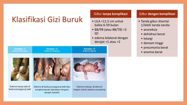Tatalaksana Gizi Buruk.pptx