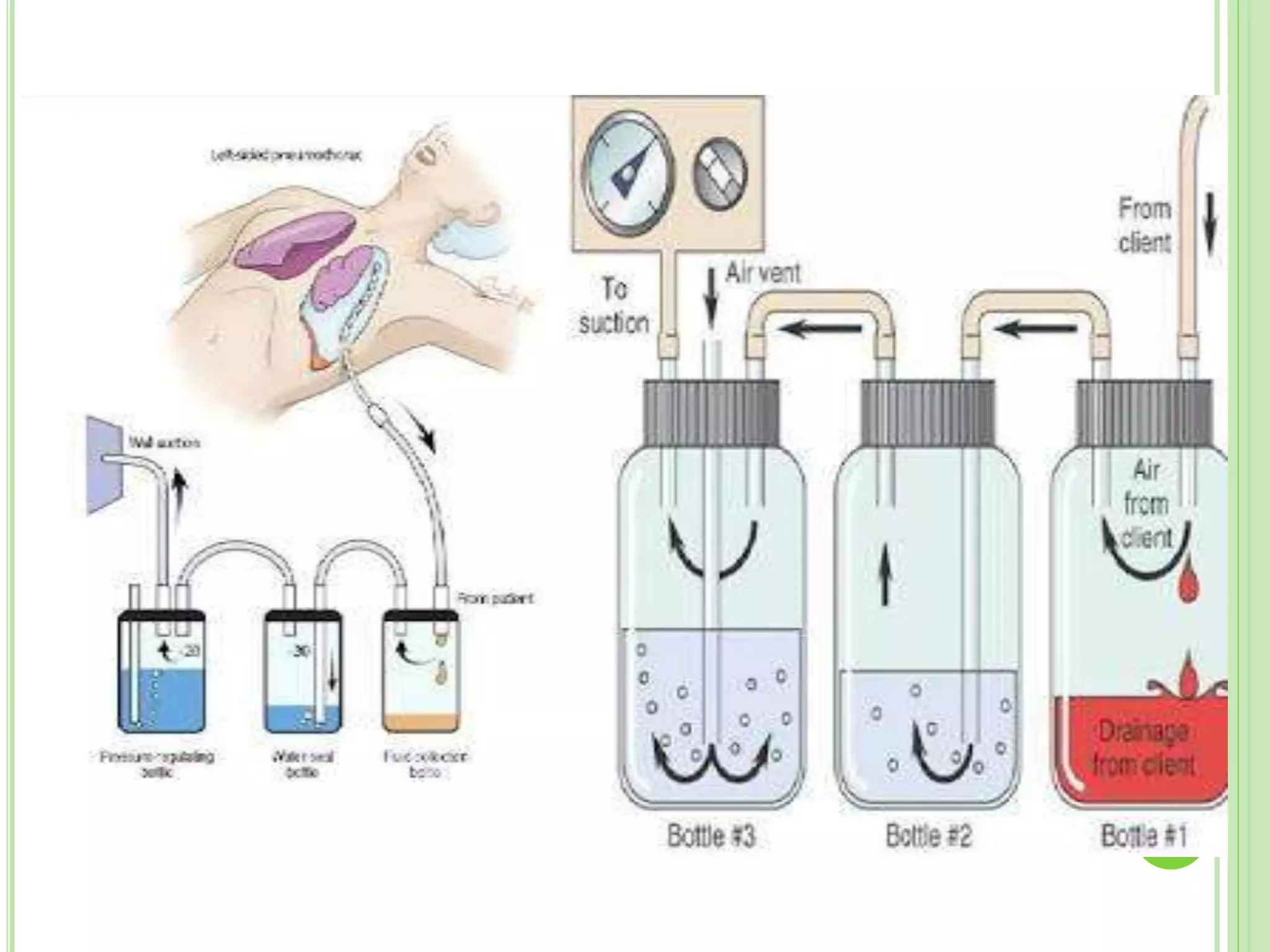 TATALAKSANA PASIEN DENGAN PEMASANGAN WSD_ANDRIANI.pptx
