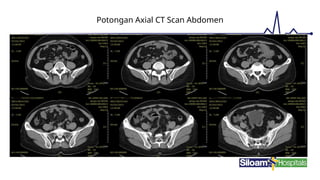 Tatalaksana Pemeriksaan CT Scan Abdomen - LG (1) (1).pptx