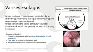 Tatalaksana perdarahan saluran cerna variseal.pptx