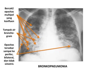 TATALAKSANA PNEUMONIA ANAK (EFIR).docx