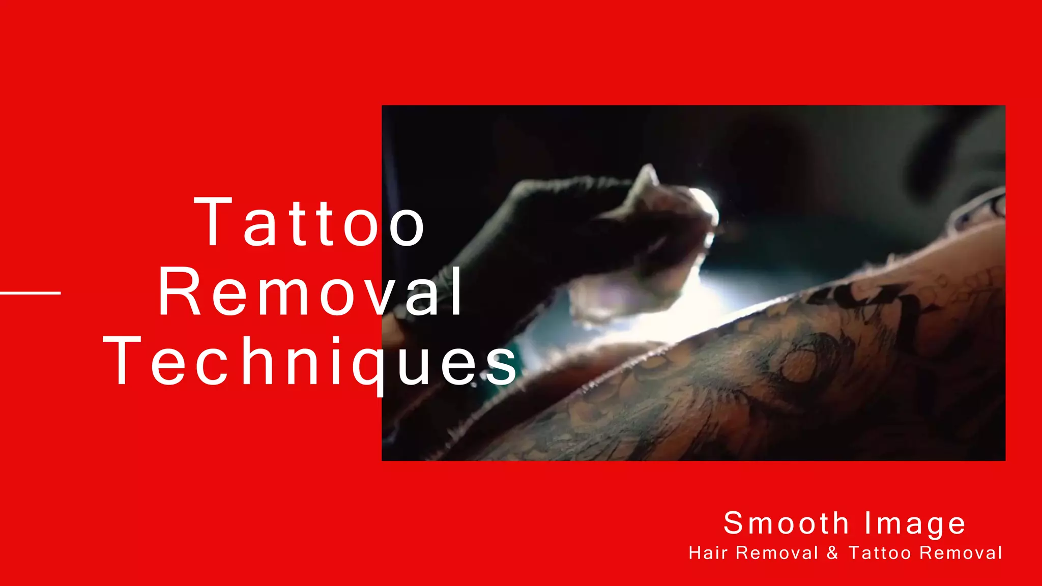 Tattoo Removal Technique | PPTX