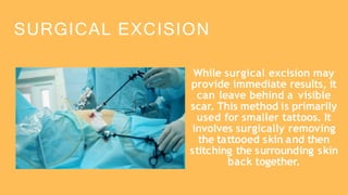 Tattoo Removal Technique | PPT