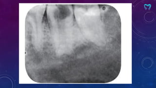 TAURODONTISM.pdf