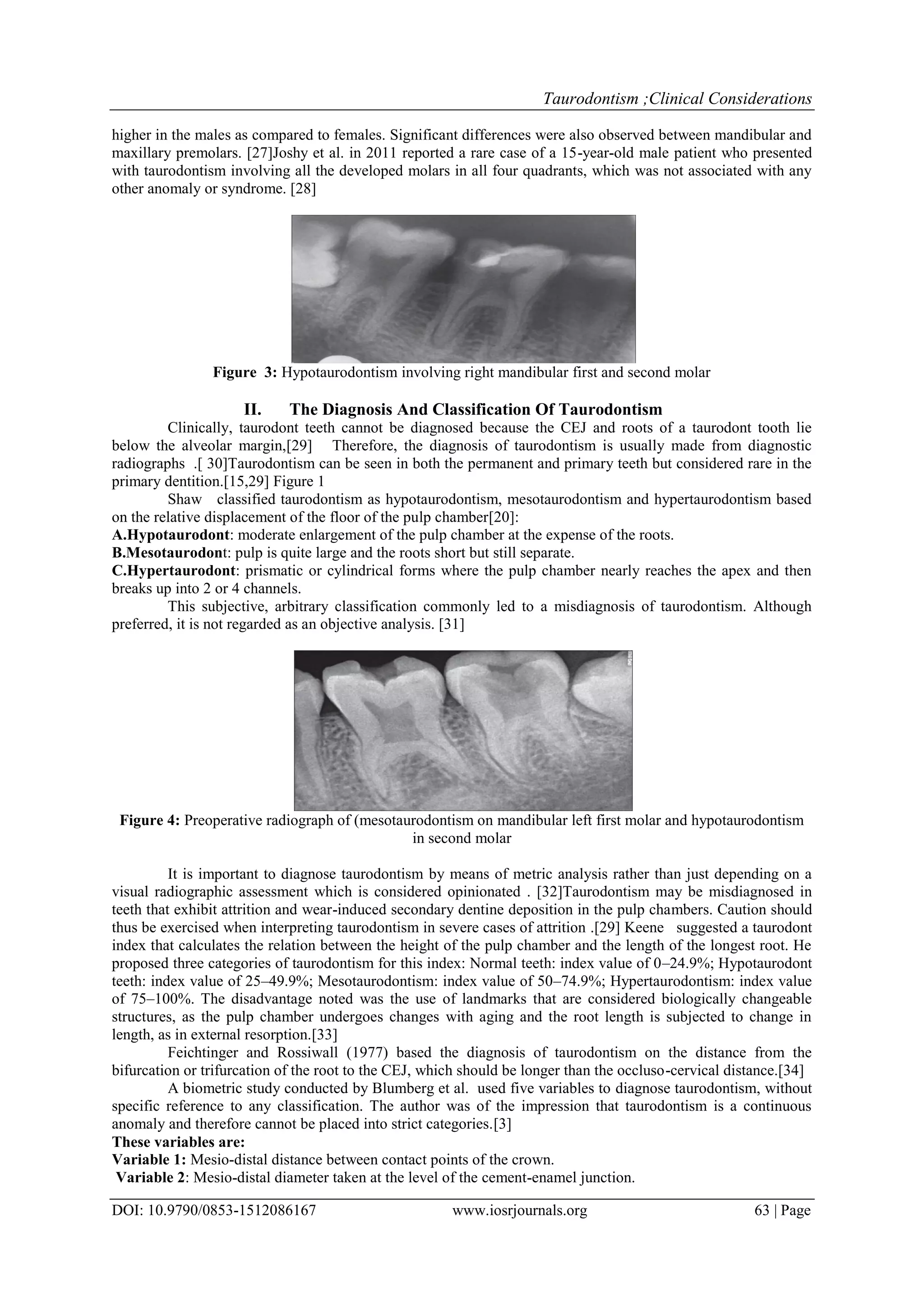 Taurodontism; clinical considerations | PDF