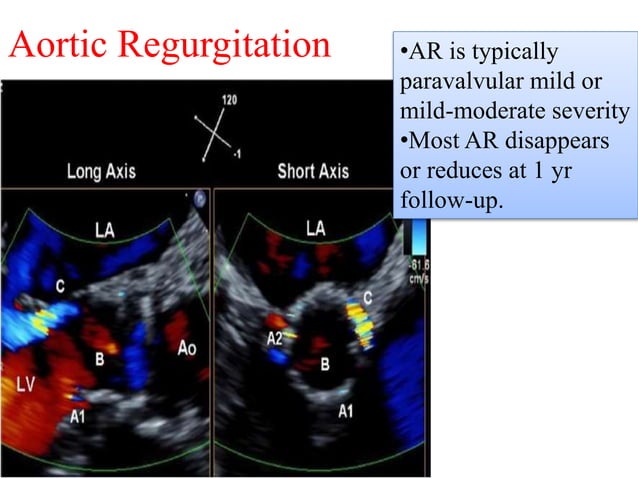 Tavi,Transcatheter Aortic Valve Replacement, TAVI,TAVR, | PPTX