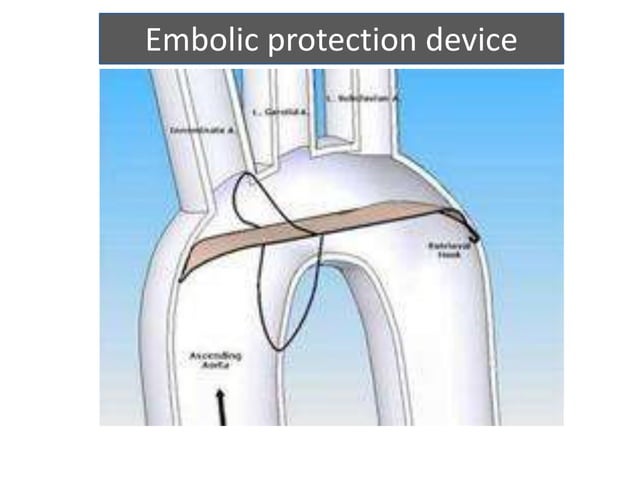 Tavi,Transcatheter Aortic Valve Replacement, TAVI,TAVR, | PPTX