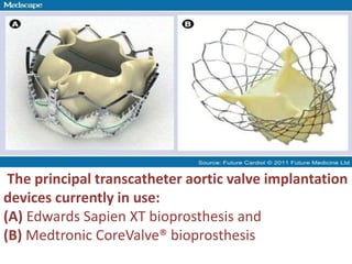 Tavi,Transcatheter Aortic Valve Replacement, TAVI,TAVR, | PPTX