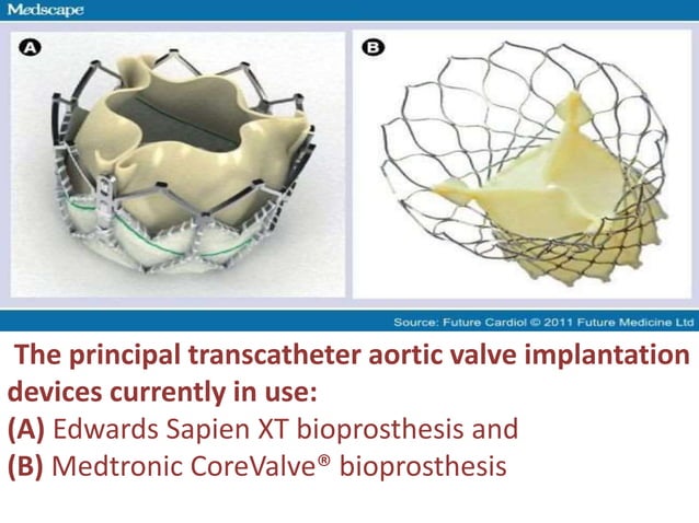 Tavi,Transcatheter Aortic Valve Replacement, TAVI,TAVR, | PPTX