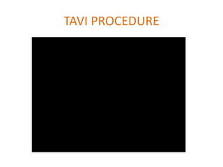 Tavi,Transcatheter Aortic Valve Replacement, TAVI,TAVR, | PPTX