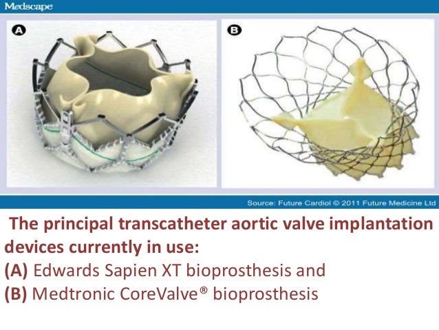Tavi,Transcatheter Aortic Valve Replacement, TAVI,TAVR,
