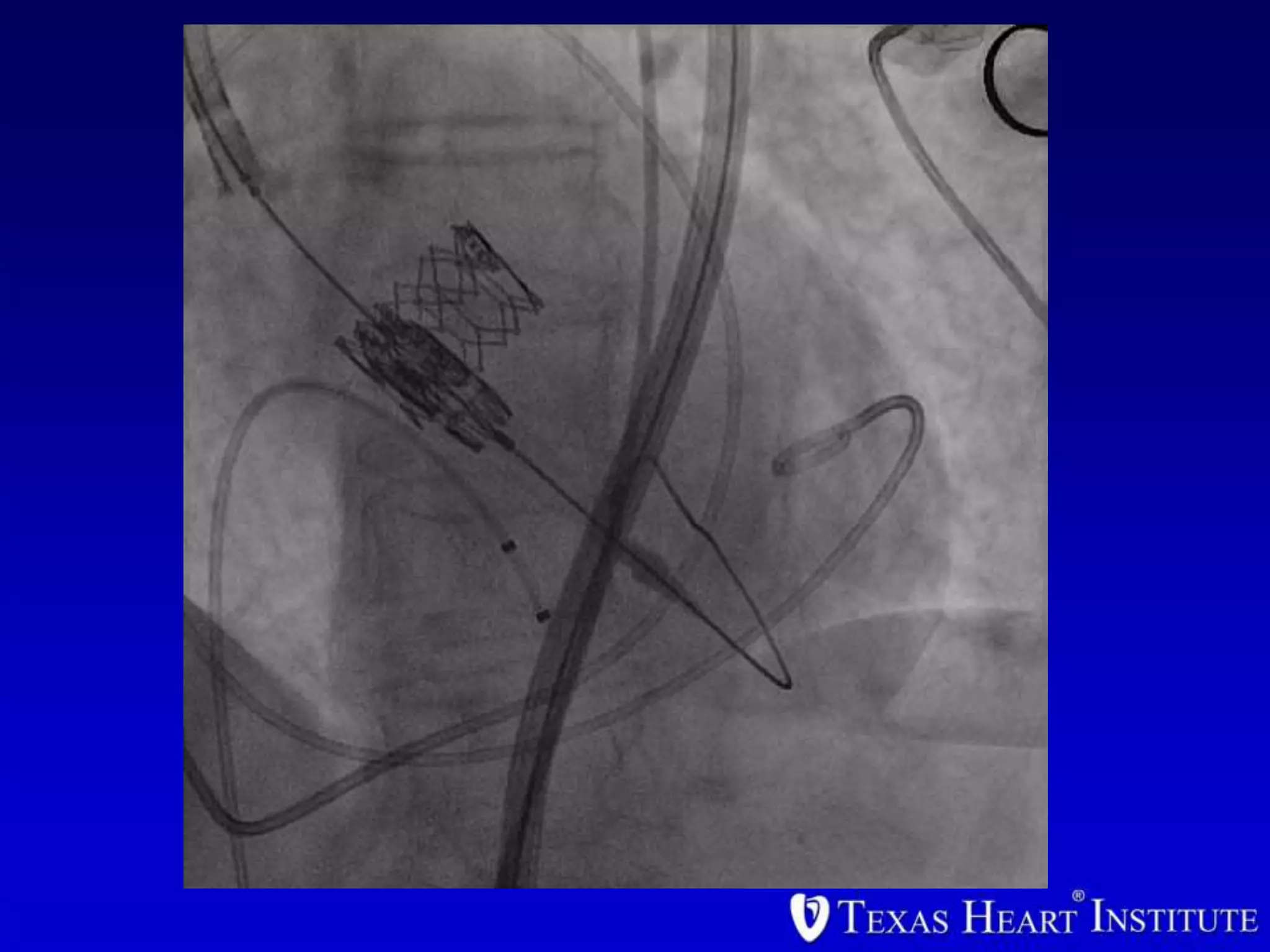 TAVI procedure review with cases | PPTX