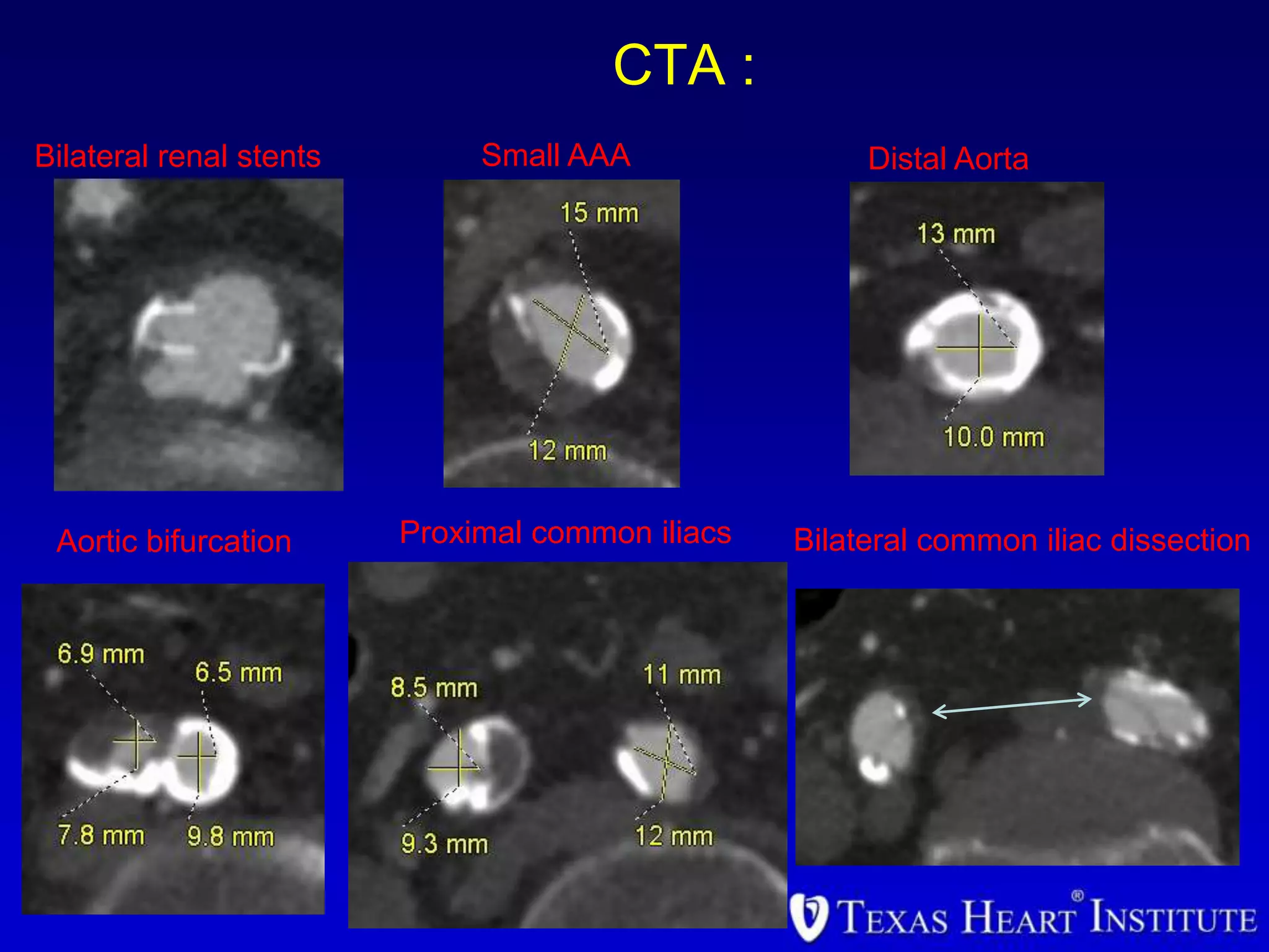 TAVI procedure review with cases | PPTX