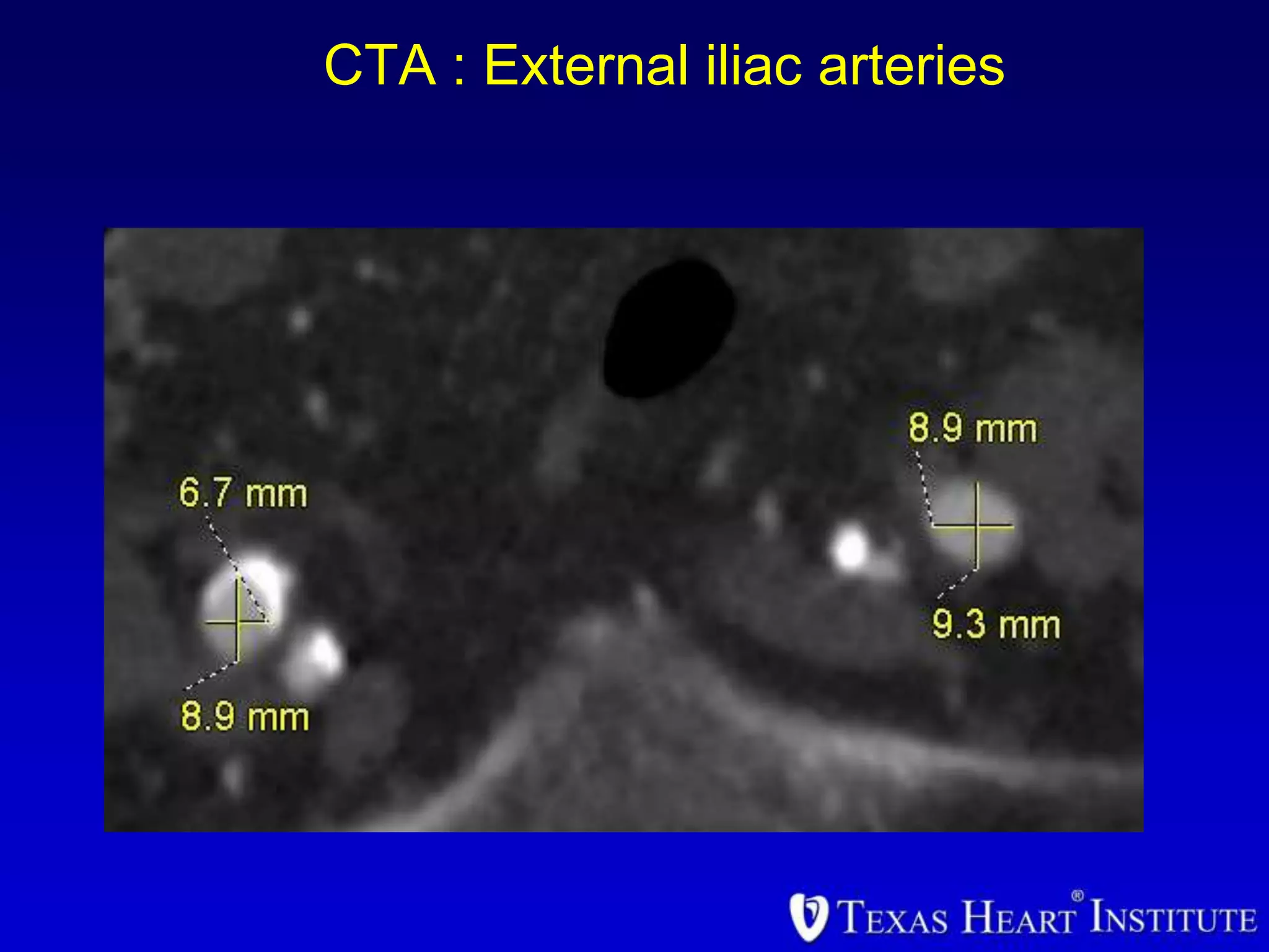 TAVI procedure review with cases | PPTX