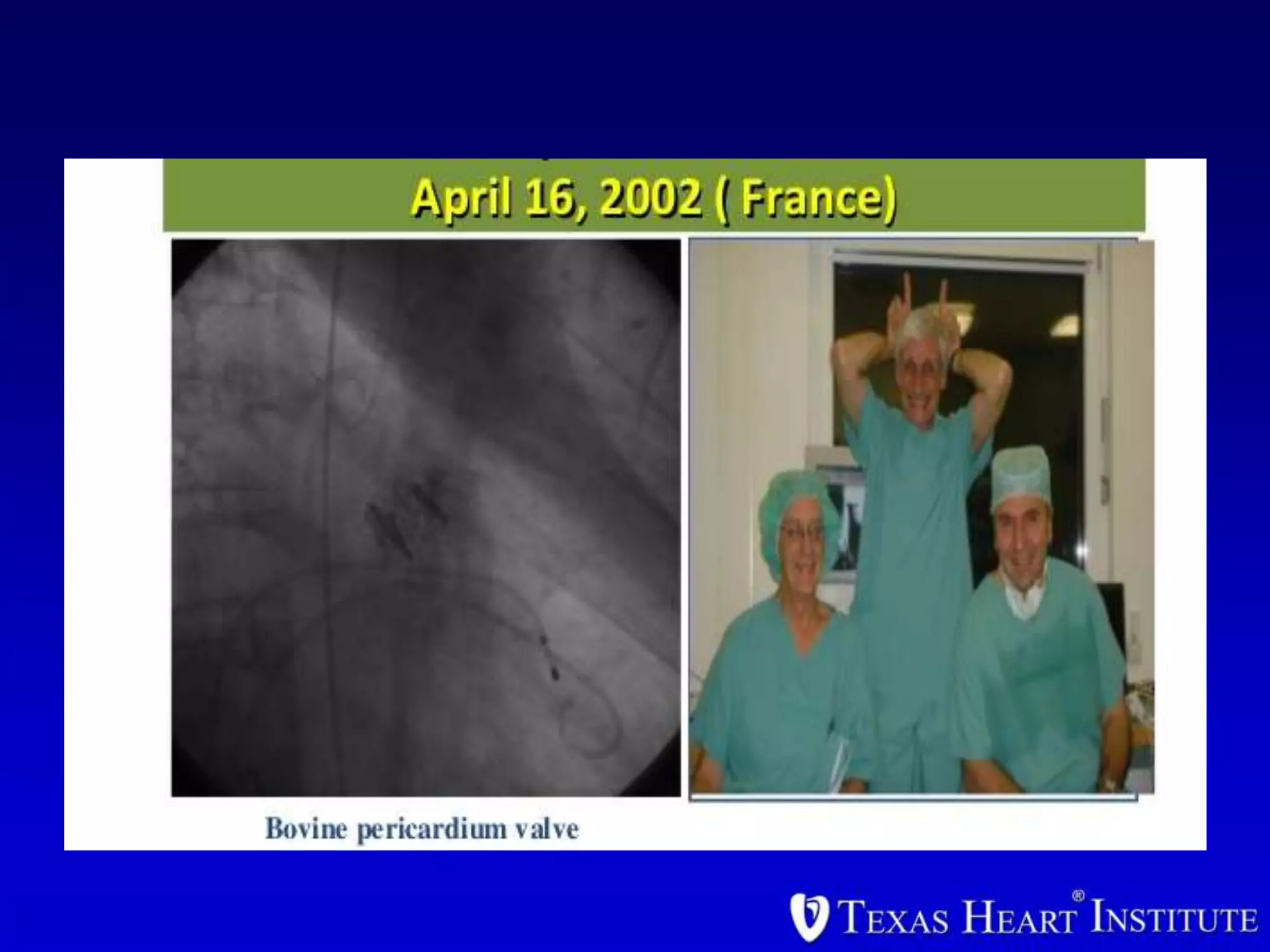 TAVI procedure review with cases | PPTX