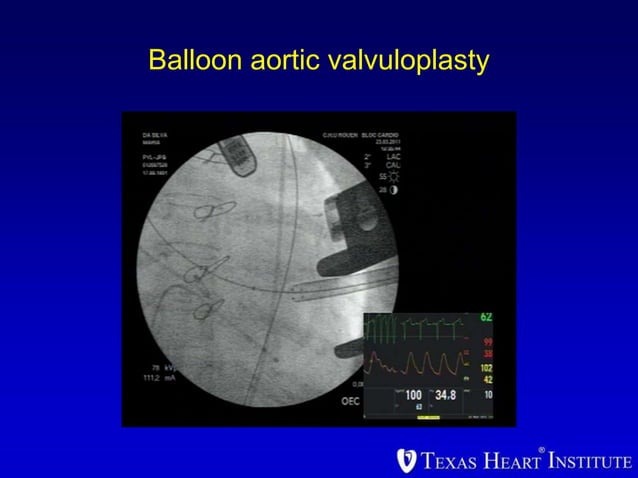 TAVI procedure review with cases | PPTX | Heart and Cardiovascular ...