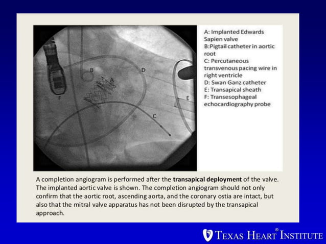 TAVI procedure review with cases | PPTX | Heart and Cardiovascular ...