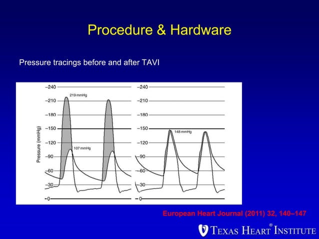 TAVI procedure review with cases | PPTX | Heart and Cardiovascular ...