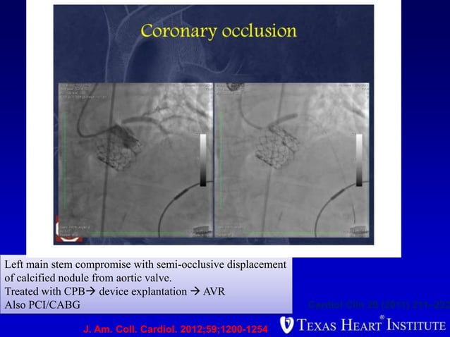 TAVI procedure review with cases | PPTX | Heart and Cardiovascular ...