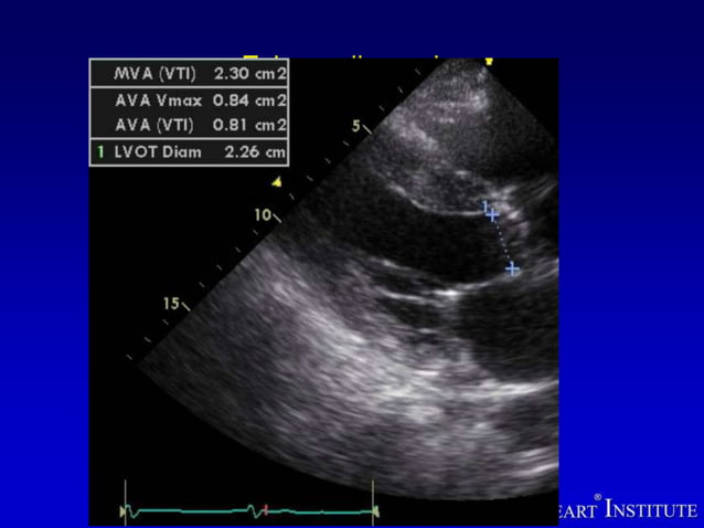 TAVI procedure review with cases | PPTX | Heart and Cardiovascular ...
