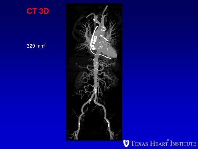 TAVI procedure review with cases