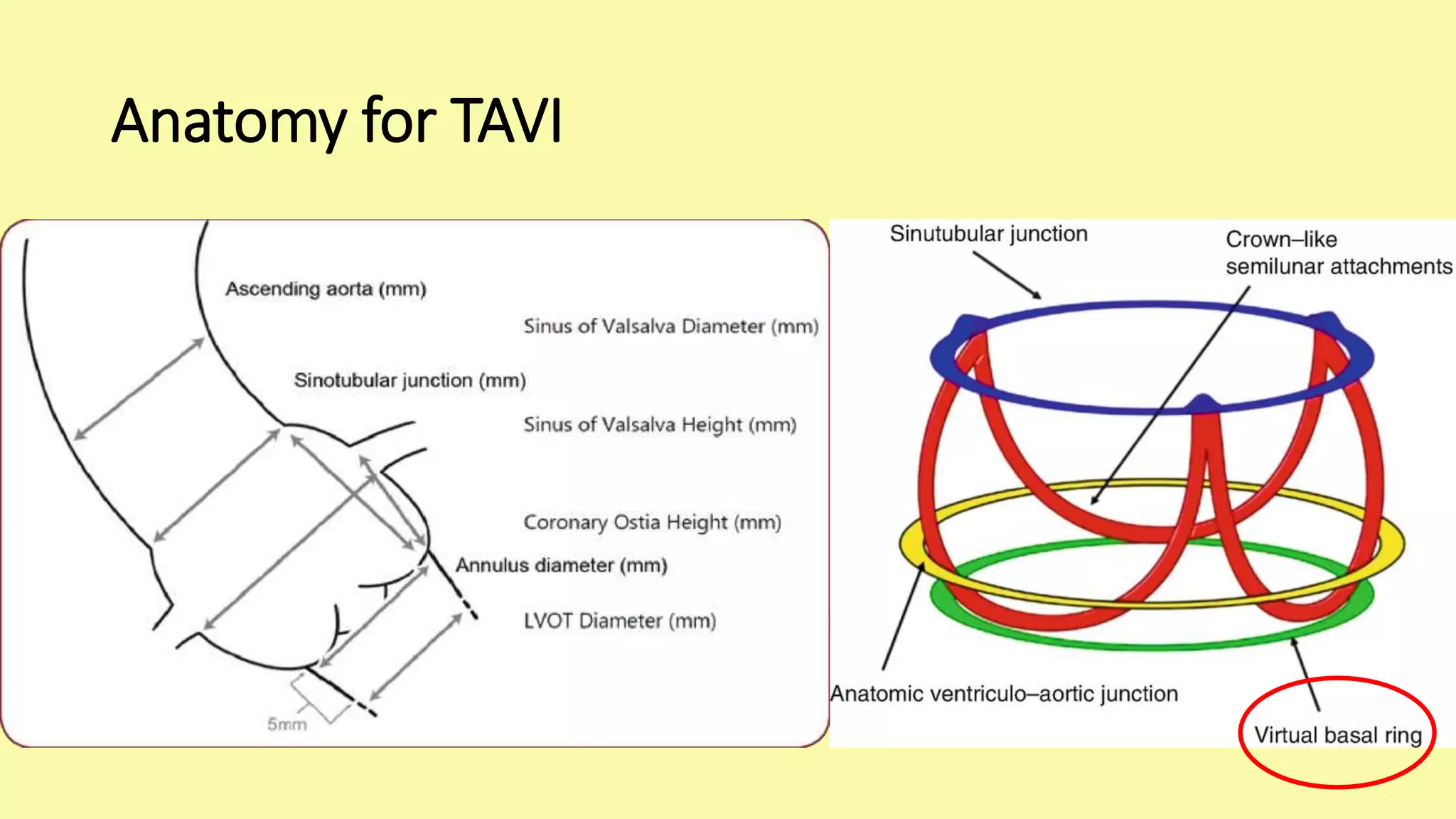 TAVI - Transcatheter Aortic Valve Implantation | PPTX