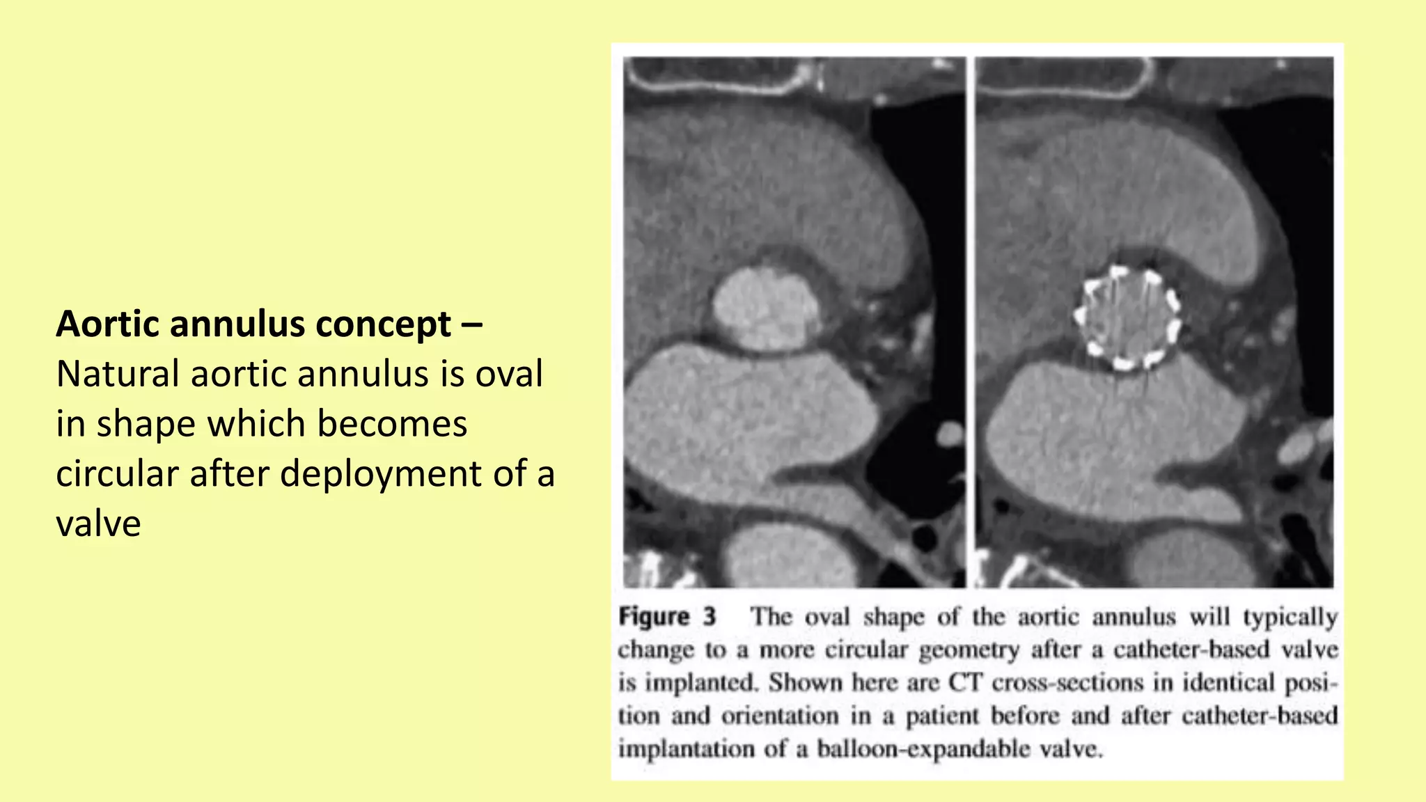 TAVI - Transcatheter Aortic Valve Implantation | PPTX