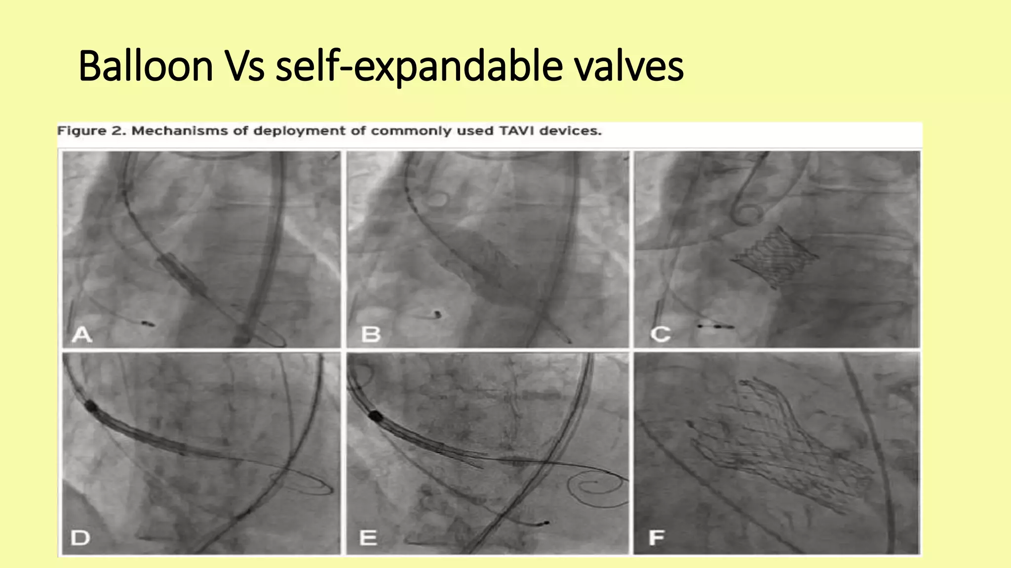 TAVI - Transcatheter Aortic Valve Implantation | PPTX